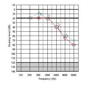 How to Read Your Hearing Test Results: The Audiogram