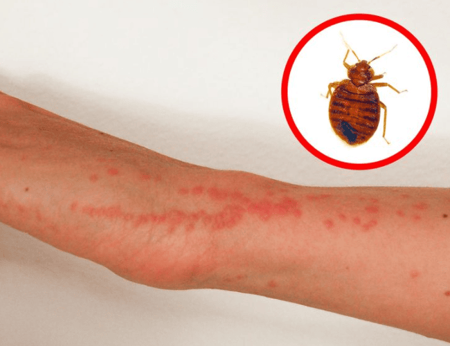 Cómo identificar una picadura de insecto y qué hacer con ella - Vida ...