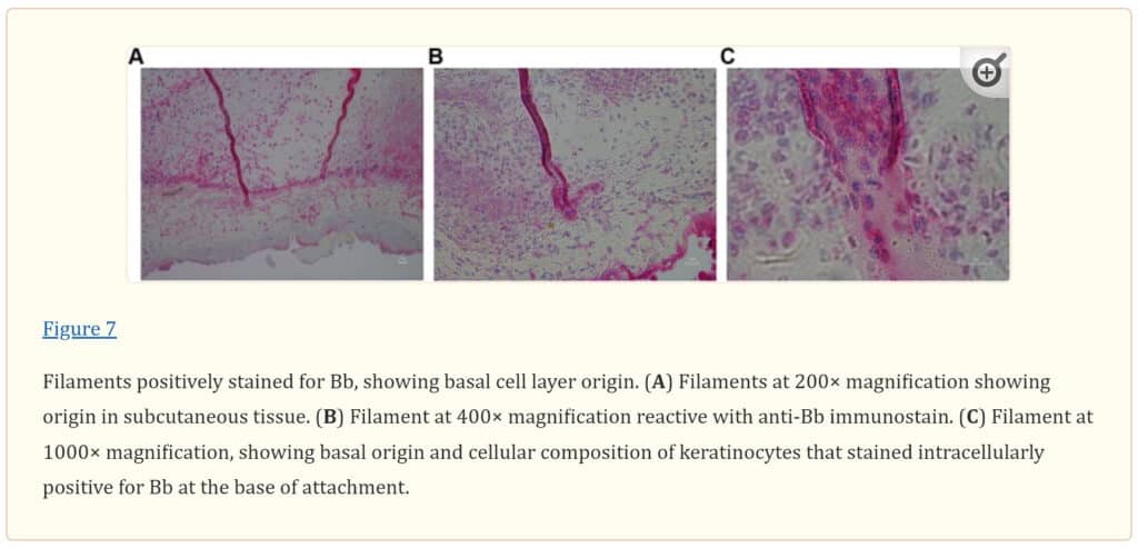 The Connection Between Lyme Disease and Morgellons: Exploring the Link ...