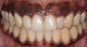 Black gums | Why do I have dark spots on my gum tissue?