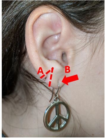 Repair of Split Earlobe Lacerations in the Urgent Care - Journal of ...