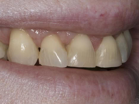 Yellow Teeth | What are the main causes of yellowing?
