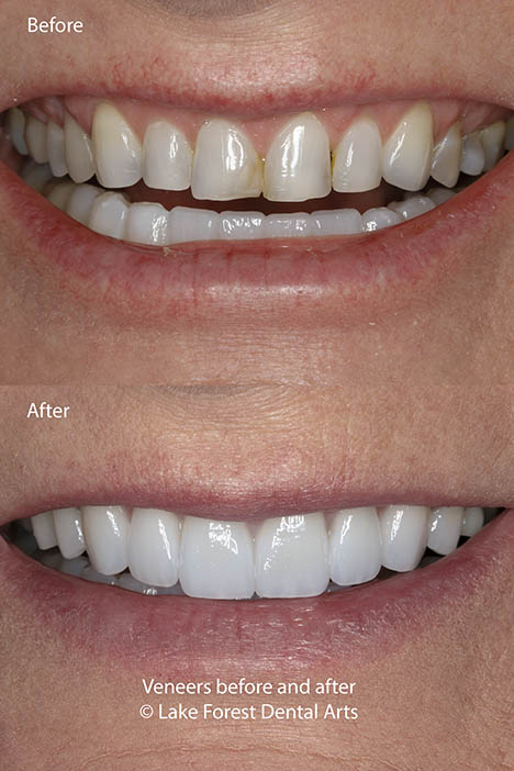Veneers vs Bonding | Choice depends on treatment goals