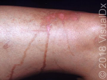 A 24-Year-Old Female with a New, Unexplained ‘Rash’ on Her Leg ...