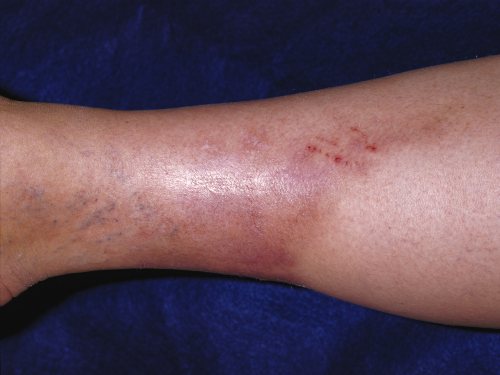 A 46-Year-Old Woman with a Painful, Erythematous Plaque on Her Leg ...