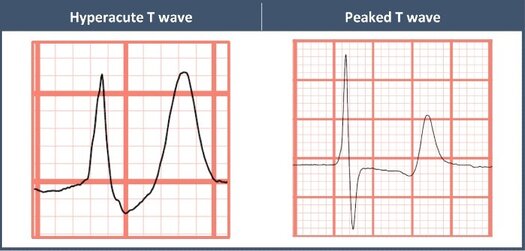 A 55-Year-Old Female with 1 Hour of Chest Pain - Page 2 of 2 - Journal ...