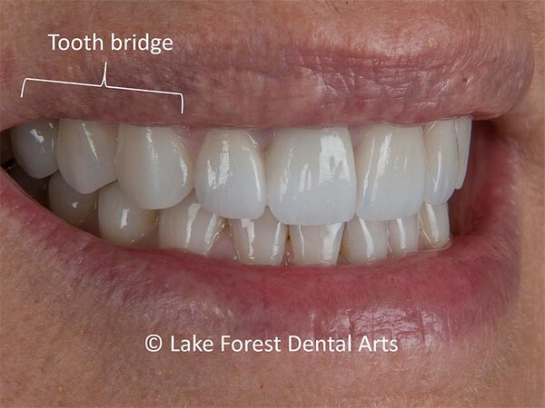 Tooth Bridge | Easy option for replacing a missing tooth