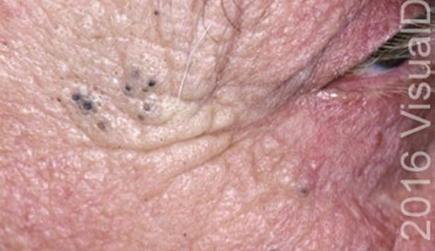 A 72-Year-Old Man with Black Skin Lesions - Page 2 of 2 - Journal of ...