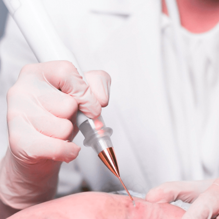 Criocirurgia com Nitrogênio líquido - Dr. Alexandre Zeni