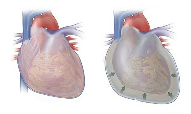 Pericardite - O que é, Sintomas e Tratamentos 【ATUALIZADO】