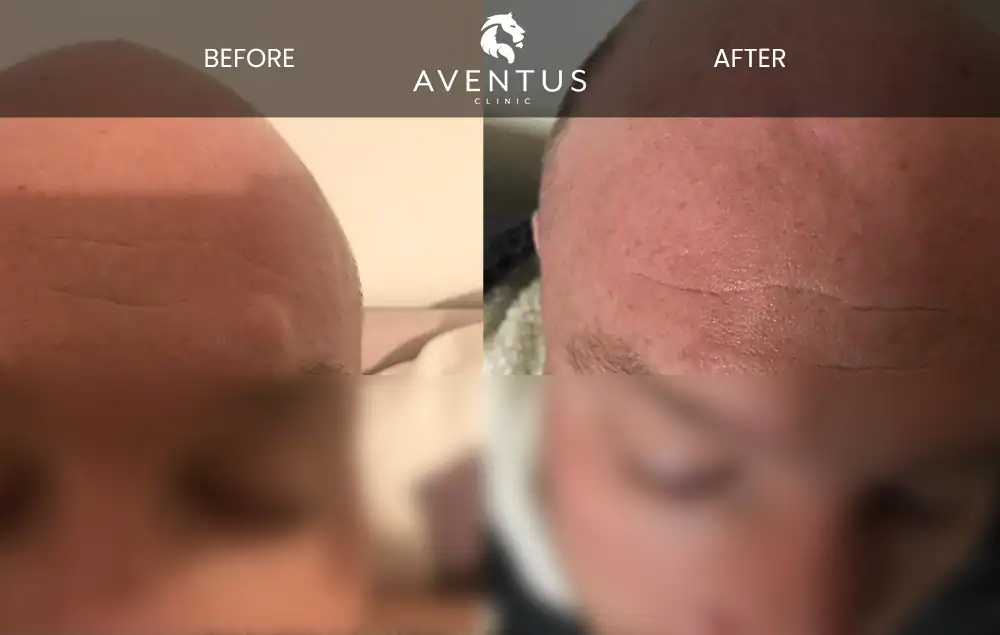 How to Remove Ingrown Hair Cysts Safely | Expert Guide