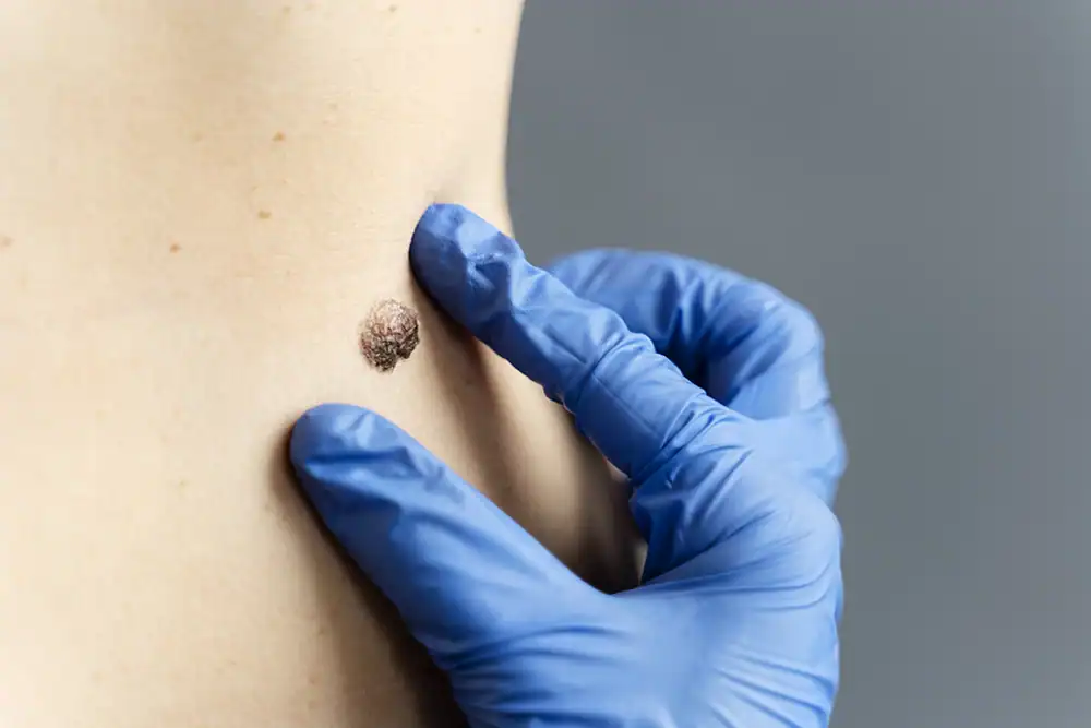 How Much Does Mole Removal Cost? | Aventus Clinic