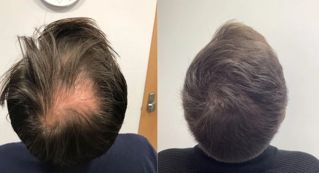 Crown Balding - Spot & Stop It In It's Tracks | Aventus Clinic