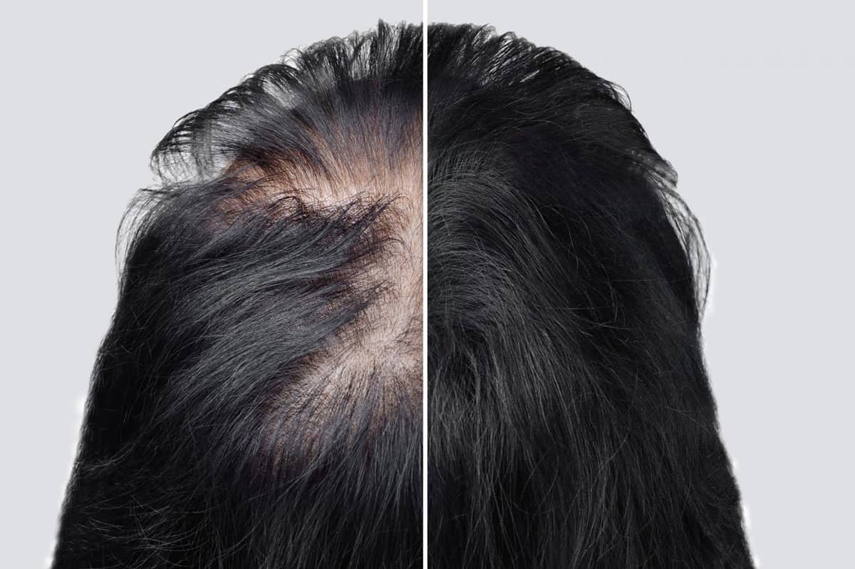Hair Transplant Infection - Signs, Causes, Risks and Treatment ...