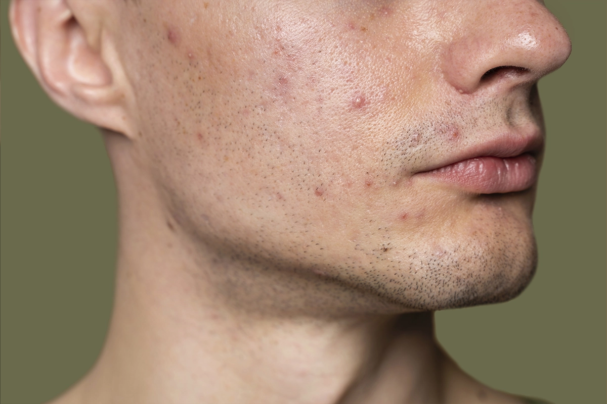 Does Creatine Cause Acne Or Make It Worse? | Aventus Clinic
