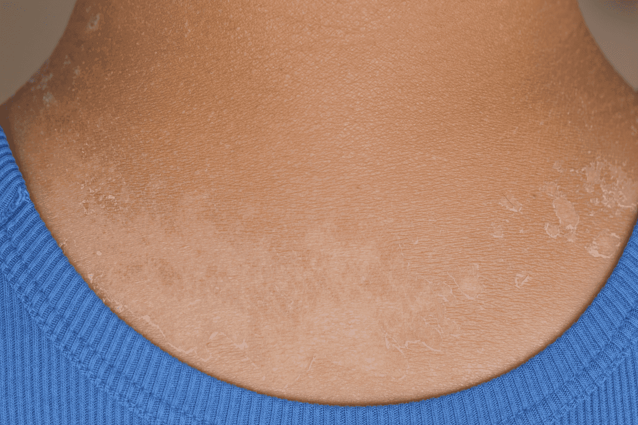 Skin Pigmentation and Discolouration Disorders - Aventus Clinic
