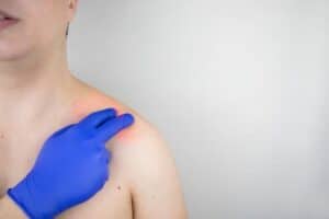 Treatment of AC Joint Shoulder Sprains