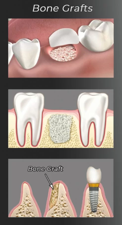 Dental Bone Graft Procedure Explained