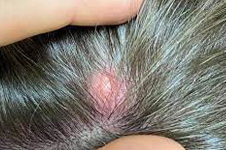 Private Cyst Removal | Same Day - £295 | Aventus Clinic | Hitchin