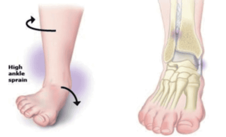 Sprained Ankle – Are they all the same?? | Evolve Physio Group