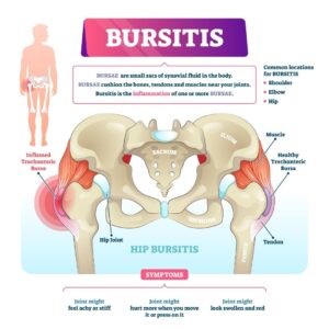 trochanteric bursitis exercises