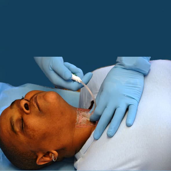 Insufflation Device - Medicare