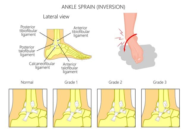 Ankle Sprains Situations With Inversion And Eversion Injury Outline ...