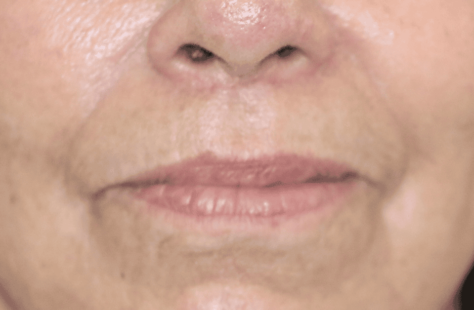 Upper Lip Lift - The Art of Beauty Plastic Surgery & MediSpa