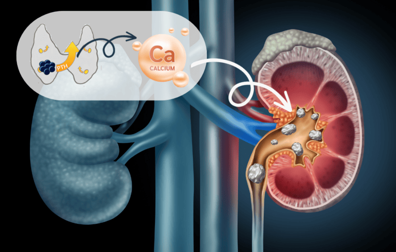 Πέτρες στα νεφρά, ασβέστιο και παραθορμόνη