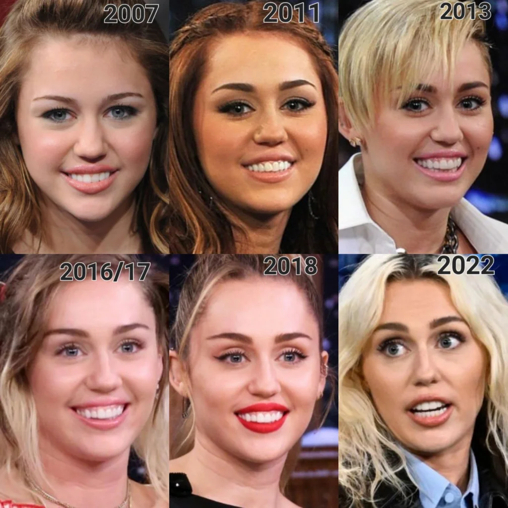 Miley Cyrus Plastic Surgery: A Comprehensive Look