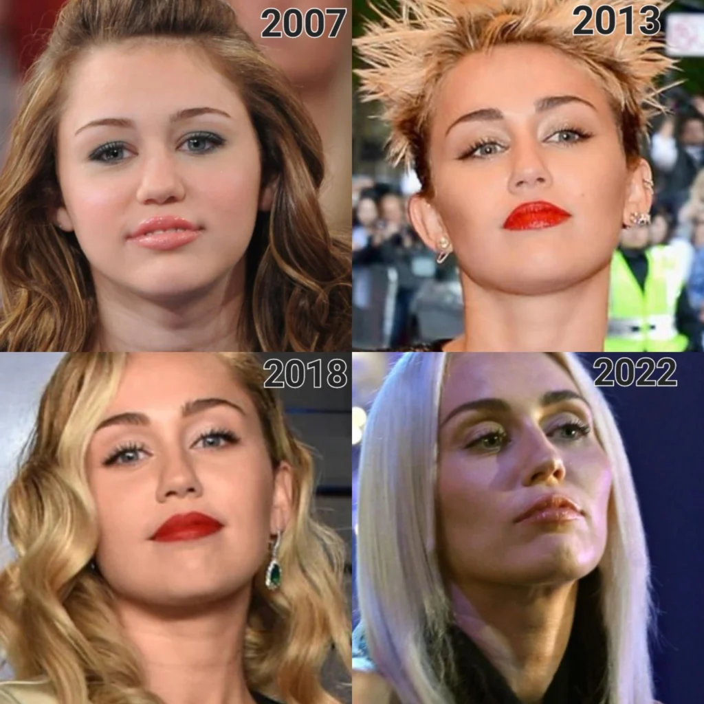 Miley Cyrus Plastic Surgery: A Comprehensive Look