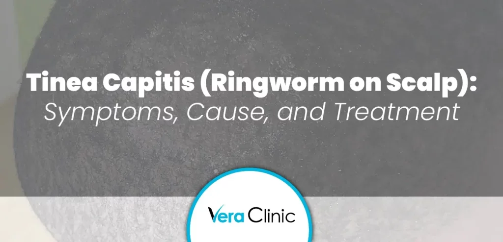 Tinea Capitis: Symptoms, Cause, and Treatment - Vera Clinic
