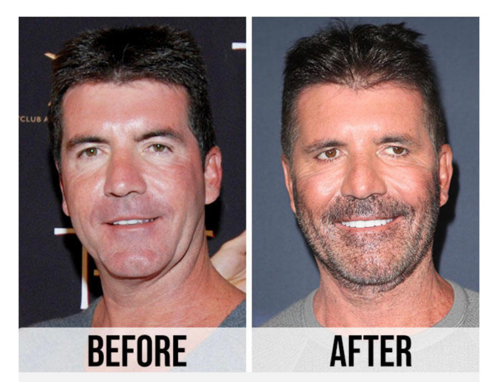 Simon Cowell Plastic Surgery: Unveiling the Impact of Cosmetic Enhancement