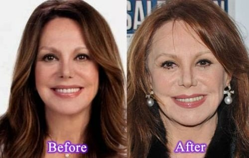 Marlo Thomas Plastic Surgery: Separating Fact from Fiction