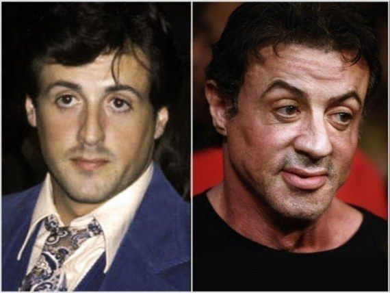 Sylvester Stallone Plastic Surgery: Age-Defying Appearance