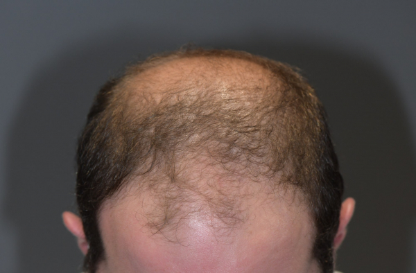 Gérer la calvitie au niveau des golfes : Stratégies et Coiffures