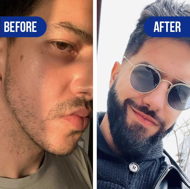 Beard Transplant Before And After - Vera Clinic
