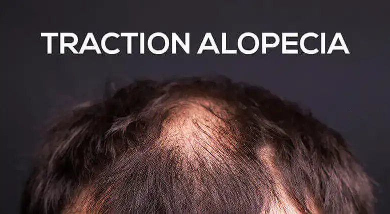 Traction Alopecia: 5 Important Facts to Know Before it’s LATE - Vera Clinic