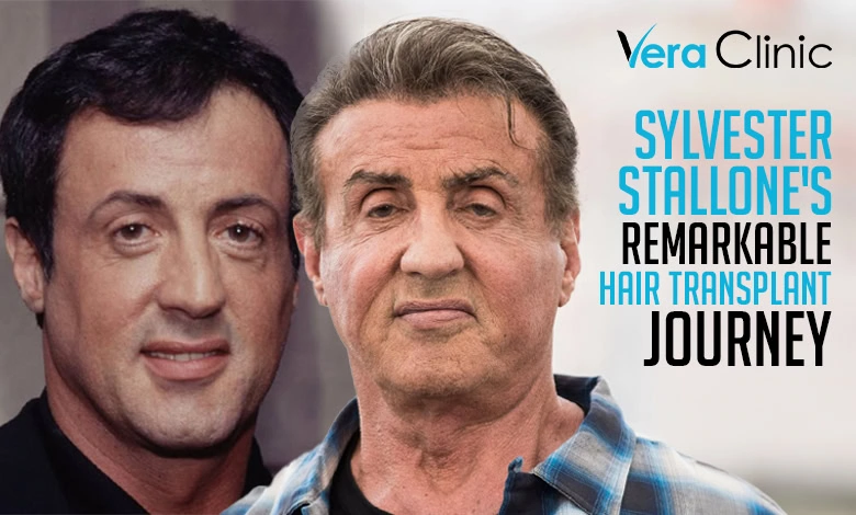 Sylvester Stallone Hair Transformation - Vera Clinic