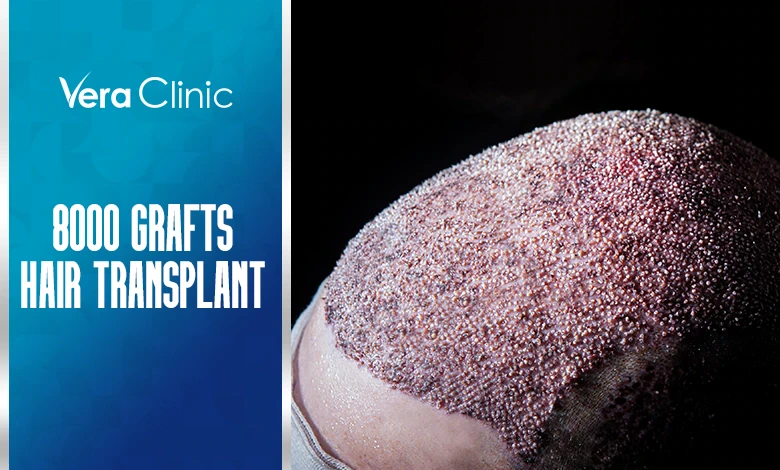 8000 Grafts Hair Transplant: All You Need to Know