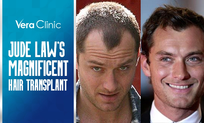 Jude Law Hair Transplant - Vera Clinic
