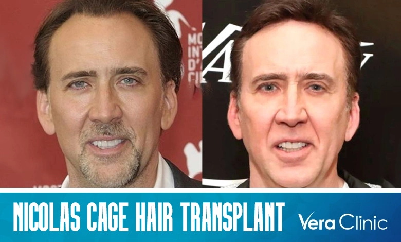 Nicolas Cage Hair Transplant