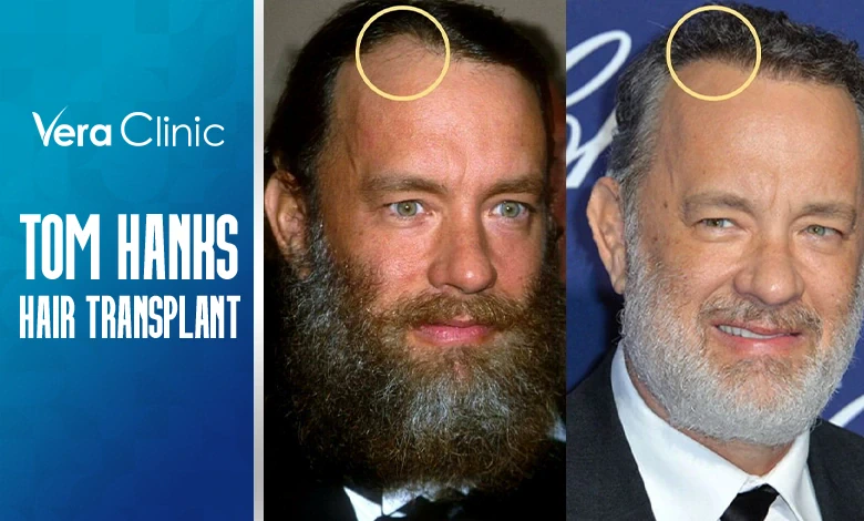 Tom Hanks Hair Transplant (Speculation and Hollywood Longevity)