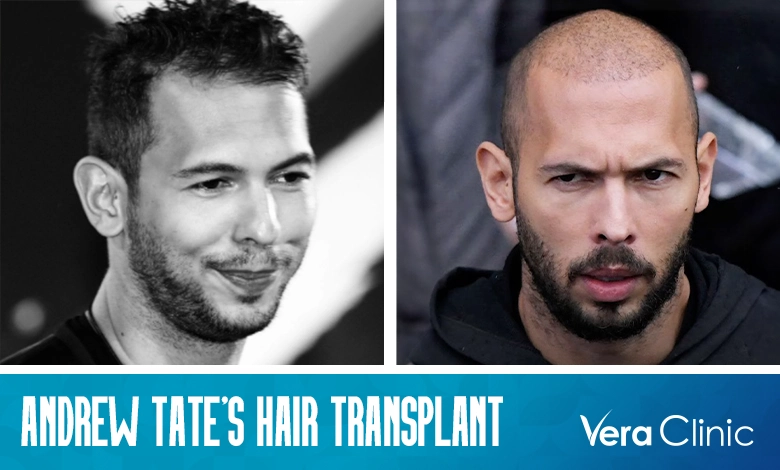 Andrew Tate Hair Transformation