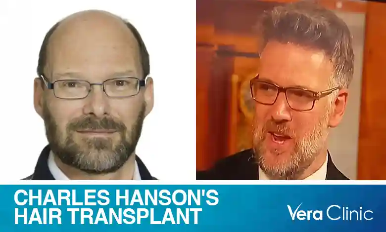 Charles Hanson Hair Transplant (Speculation and Media Attention)