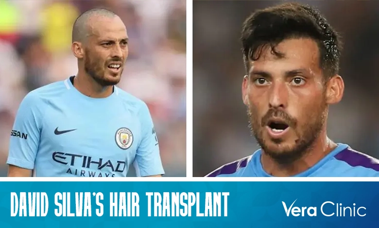 David Silva Hair Transplant
