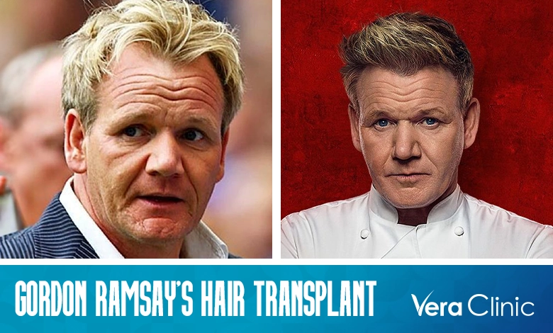 Gordon Ramsay Hair Transplant