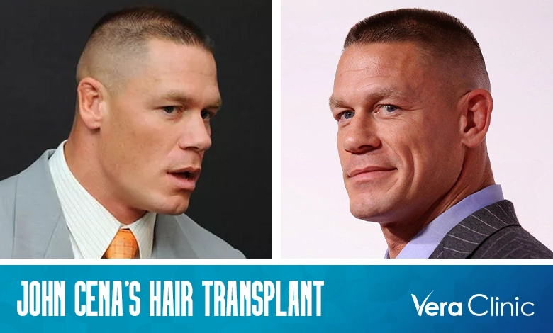 John Cena Hair Transplant
