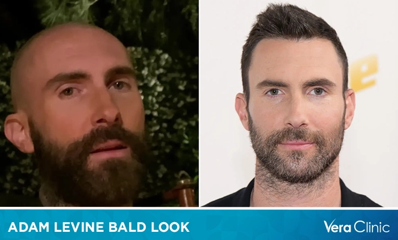 Adam Levine Bald Look: Analyzing His Hair Evolution