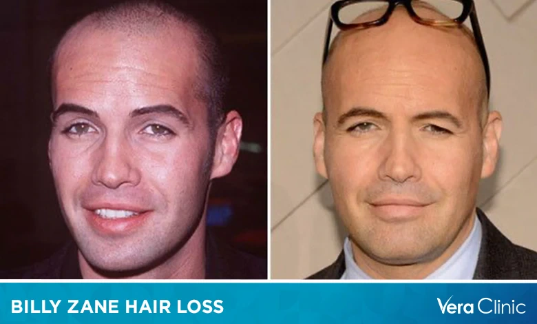 Billy Zane Hair Transplant (or Embracing Baldness?)